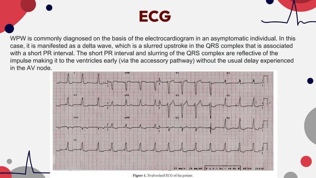 WPW SYNDROME pROJECT.pptx