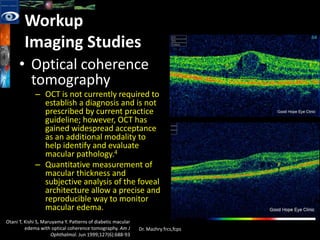 Diabetic Macular Edema Oct