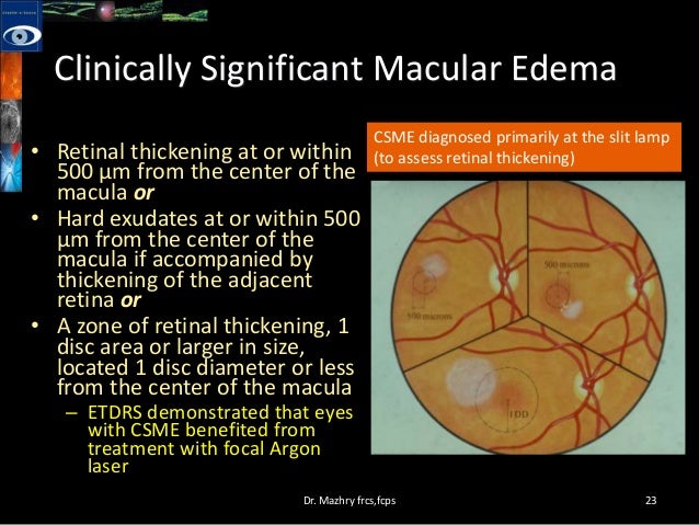 Diabetic macular edema-Current treatment Modalities