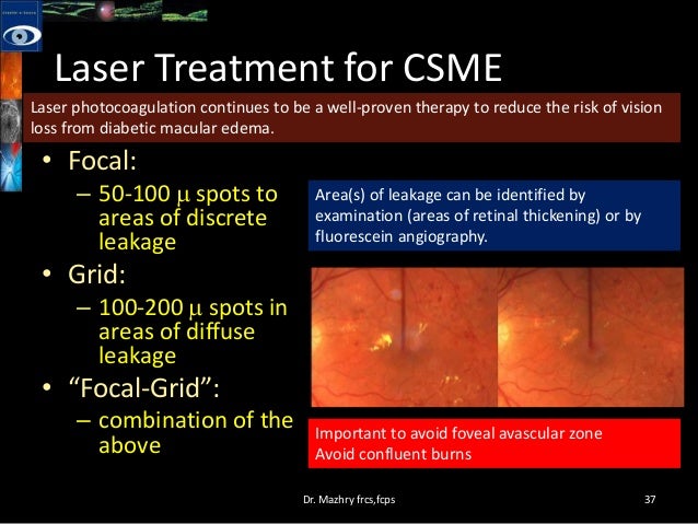 Diabetic macular edema-Current treatment Modalities