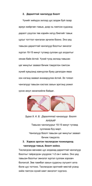 Осол гэмтлийн үед үзүүлэх анхны тусламж Pdf