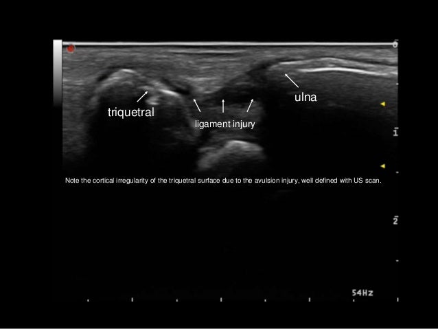 Wrist Ultrasound