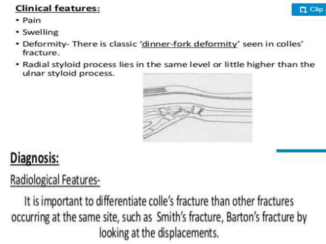 elbow and wrist and hand fracture with management | PPTX | Death ...