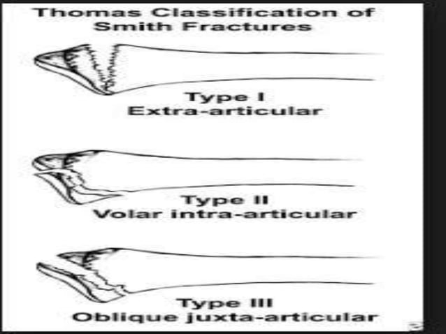 elbow and wrist and hand fracture with management | PPTX | Death ...