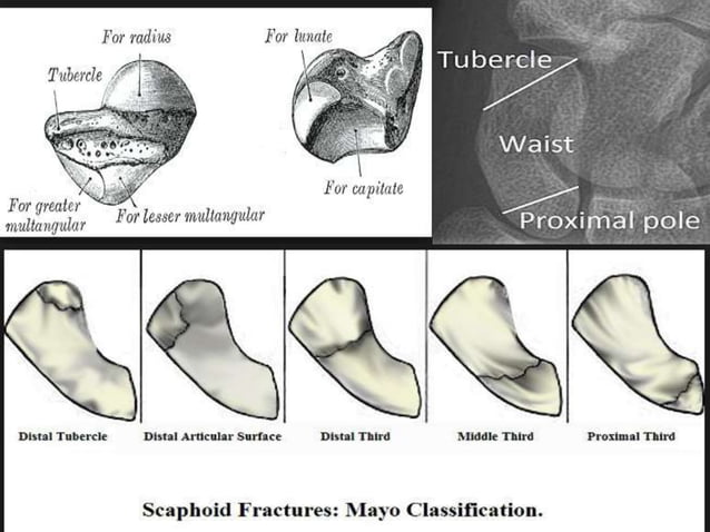 elbow and wrist and hand fracture with management | PPTX | Death ...