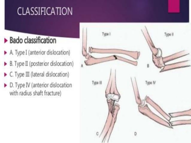 elbow and wrist and hand fracture with management | PPTX | Death ...