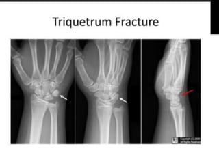 elbow and wrist and hand fracture with management | PPTX