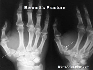 elbow and wrist and hand fracture with management | PPTX