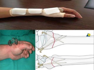 elbow and wrist and hand fracture with management | PPTX