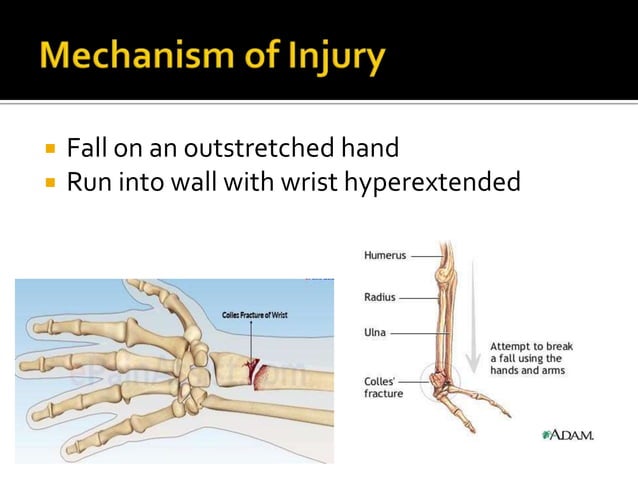 elbow and wrist and hand fracture with management | PPTX | Death ...