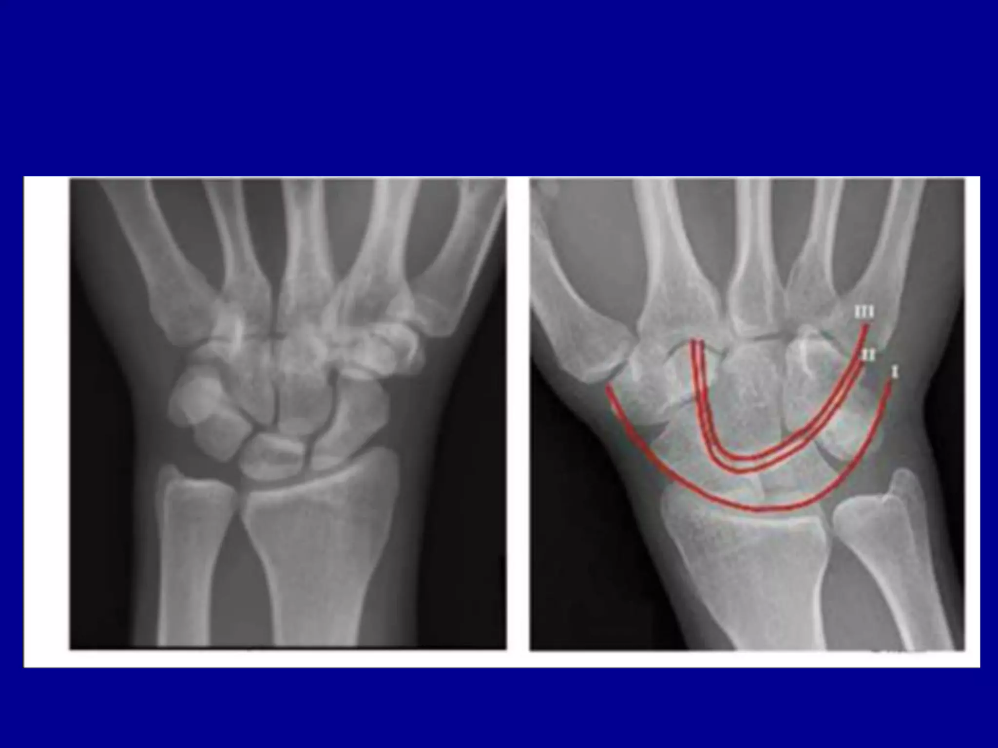 Chronic Wrist Pain And Examination | PPTX