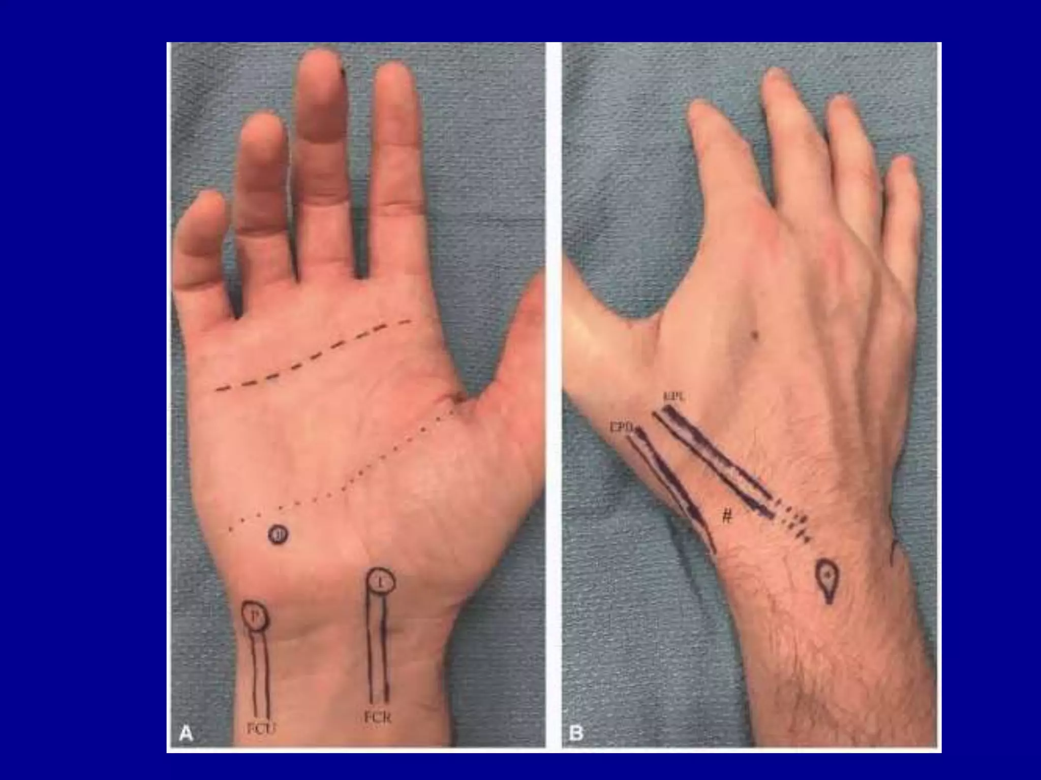 Chronic Wrist Pain And Examination | PPTX