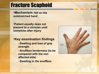 hand injuries in sports | PPT