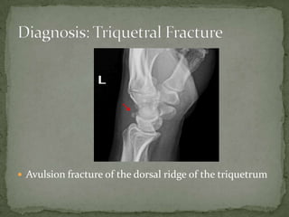 Triquetral Fracture | PPTX
