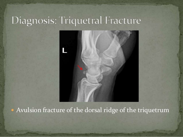 Triquetral Fracture