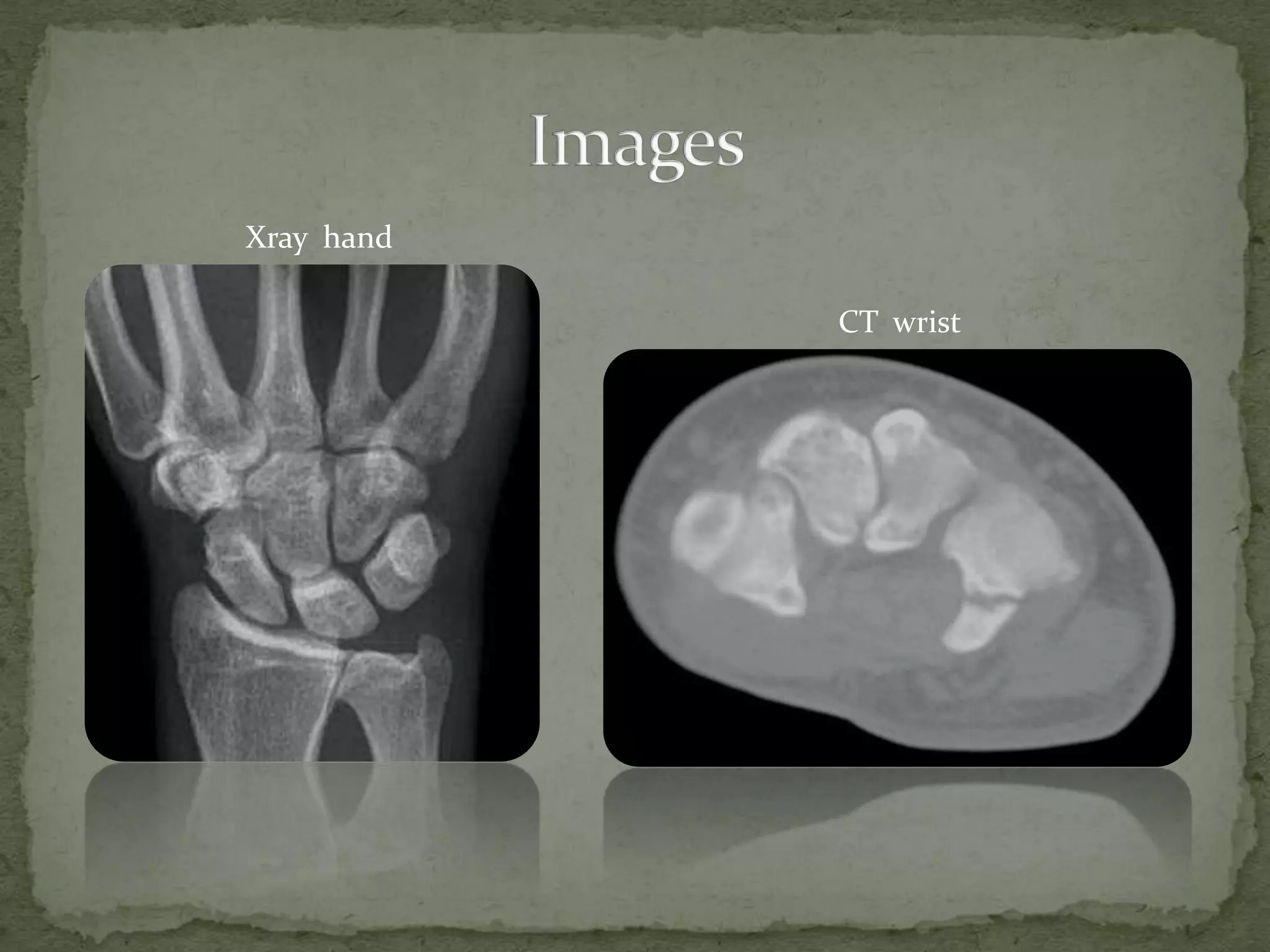 Hamate Fracture | PPTX