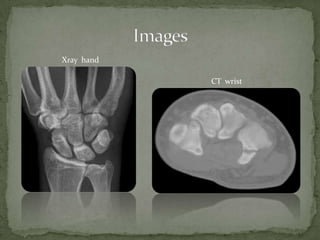 Hamate Fracture | PPTX