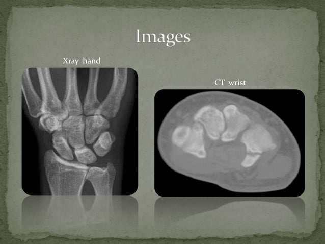 Hamate Fracture | PPTX