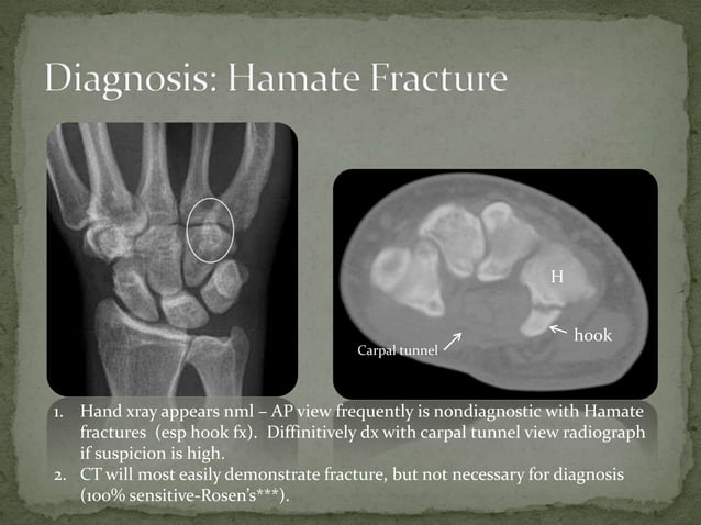 Hamate Fracture | PPTX