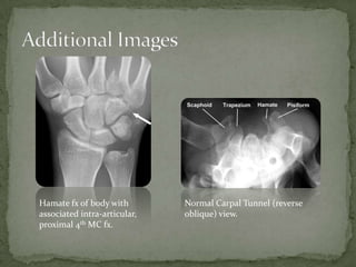 Hamate Fracture | PPTX