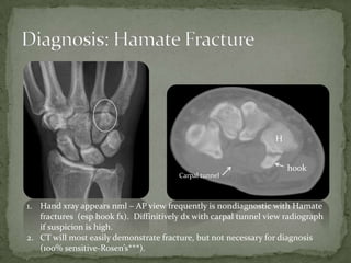 Hamate Fracture | PPT