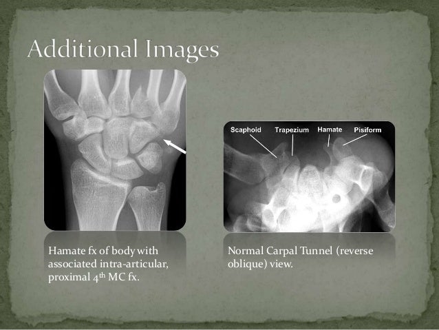 Hamate Fracture