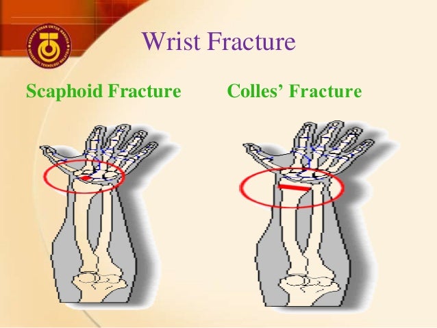 Sport Injuries - Wrist and Fingers Injuries
