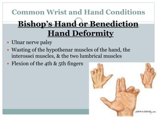 Bishops Deformity Medial Nerve