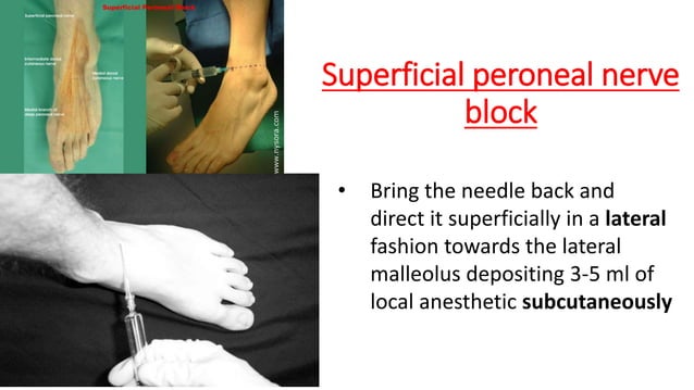 WRIST BLOCK, ANKLE BLOCK HIMANSHU BAXY.pptx | Death, Injury, or ...