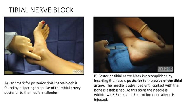 WRIST BLOCK, ANKLE BLOCK HIMANSHU BAXY.pptx | Death, Injury, or ...