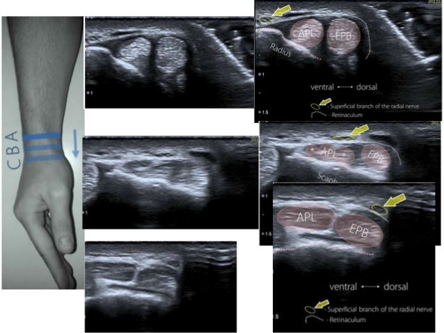 MSK US of Wrist & Hand