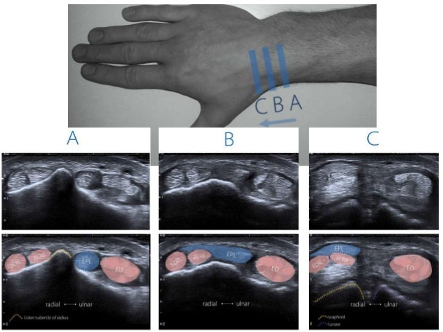 MSK US of Wrist & Hand