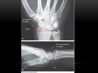 Wrist & hand complex | PPTX