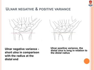 Wrist joint complex | PPT