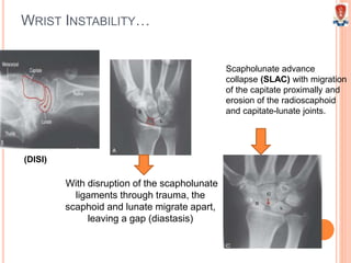 Wrist joint complex | PPT