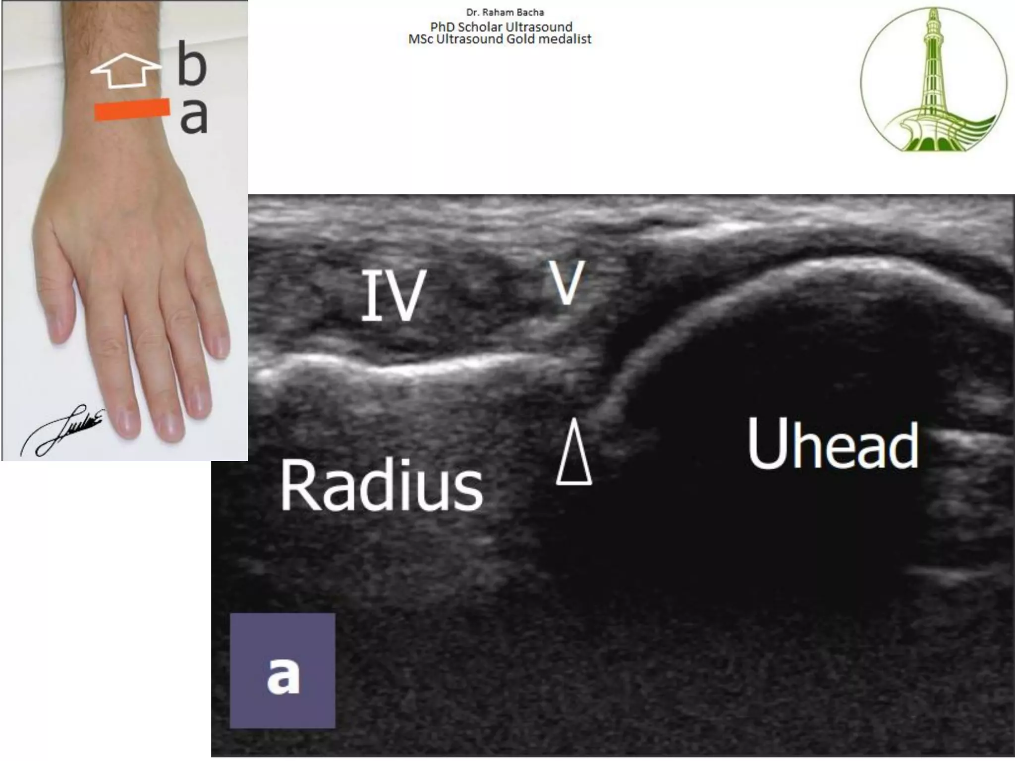 Wrist joint ultrasound | PDF