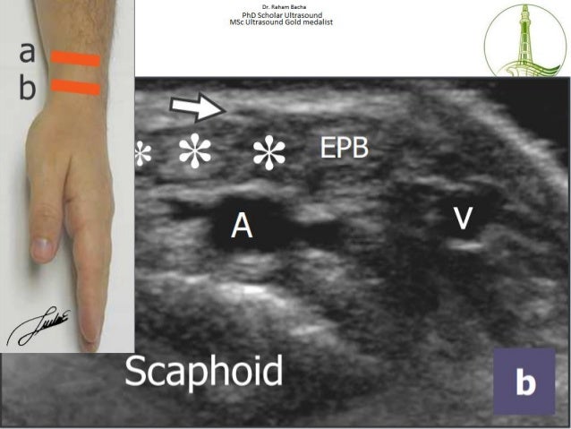 Wrist Joint Ultrasound