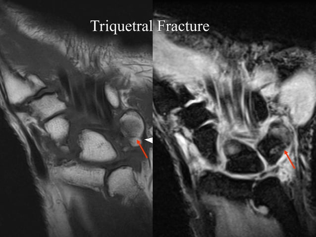 Wrist MRI Magnetic Resonance Imaging.ppt