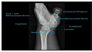 WRIST RADIOGRAPHY , Bathmahariswaran (1).pptx