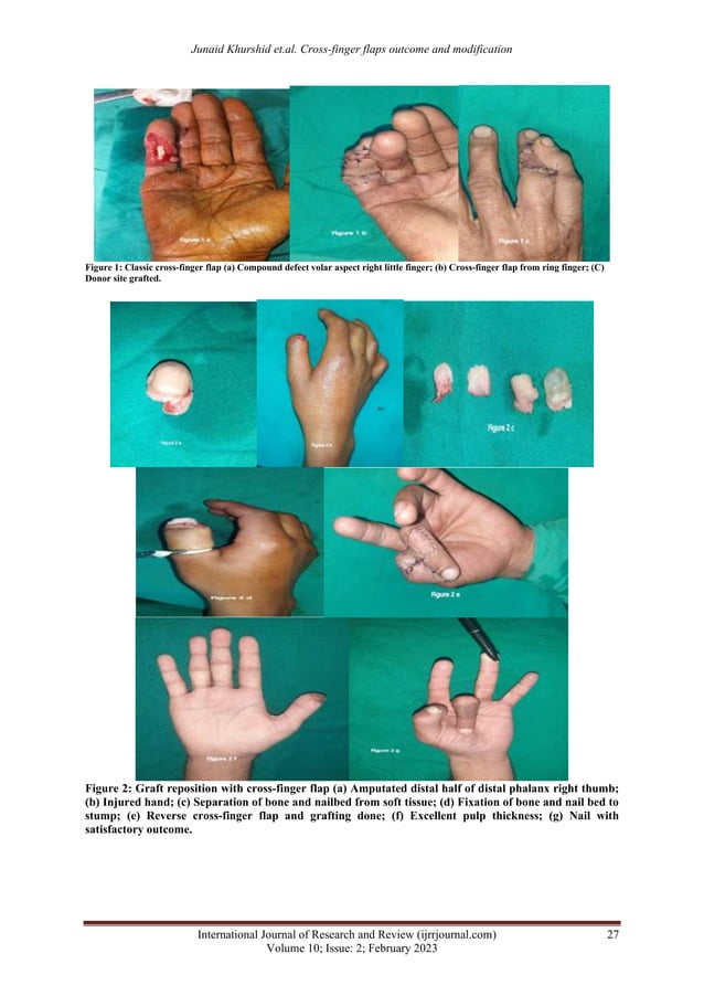 Cross Finger flap.pdf | First Aid | Injuries