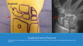 Wrist joint overuse and sport injuries | PDF