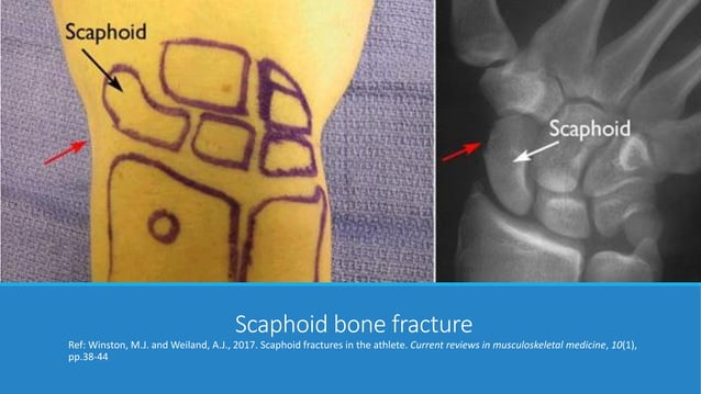 Wrist joint overuse and sport injuries | PPT