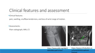 Wrist joint overuse and sport injuries | PDF