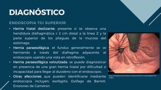 Hernia Hiatal | PDF