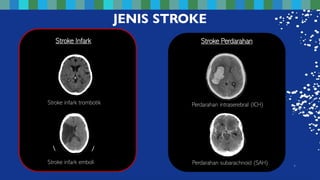 World Stroke Day Penyuluhan Stroke Dokter Umum.pdf