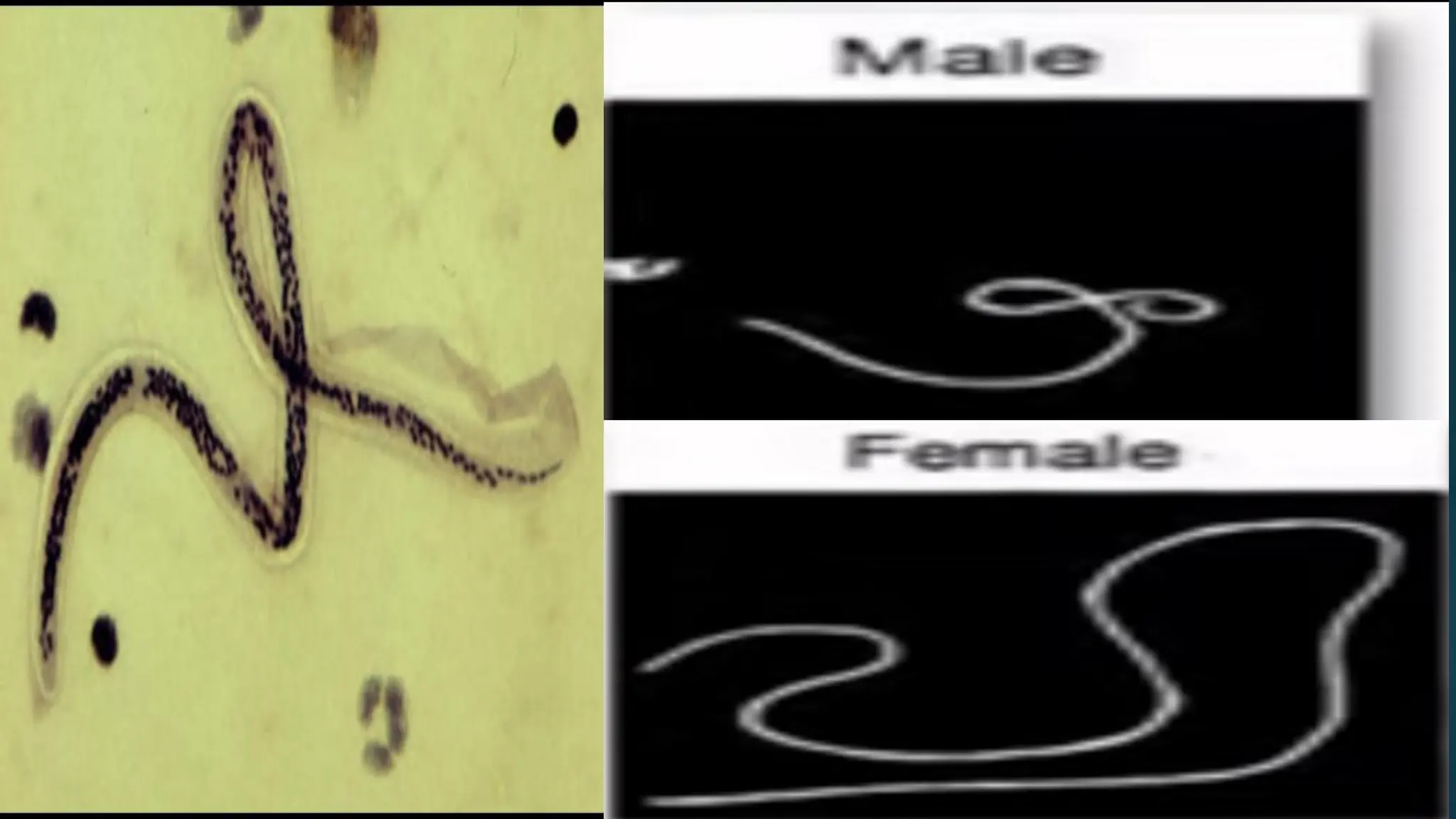 Wuchereria bancrofti and elephantiasis.pptx