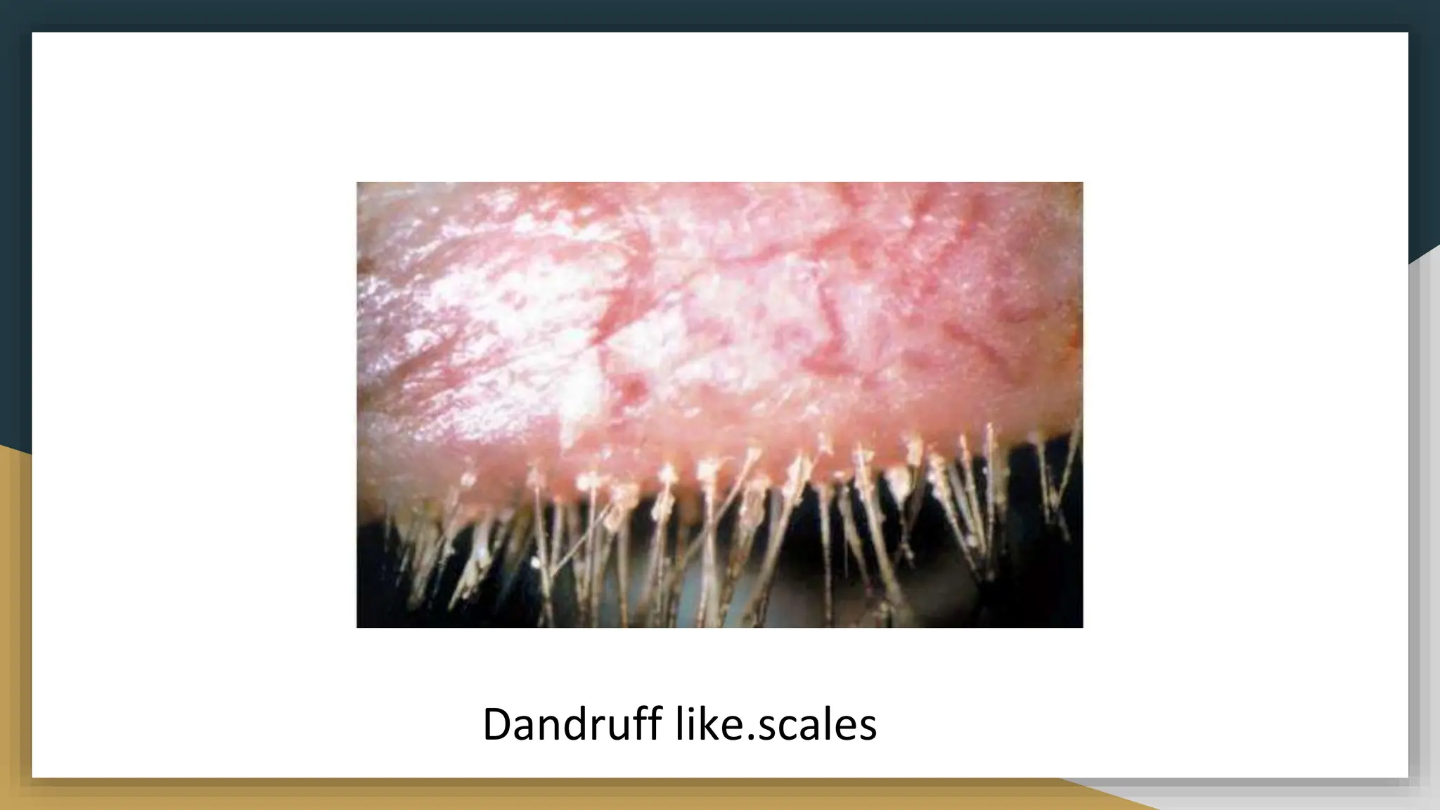BLEPHARITIS - introduction, types, Etiology, pathogenesis, clinical ...