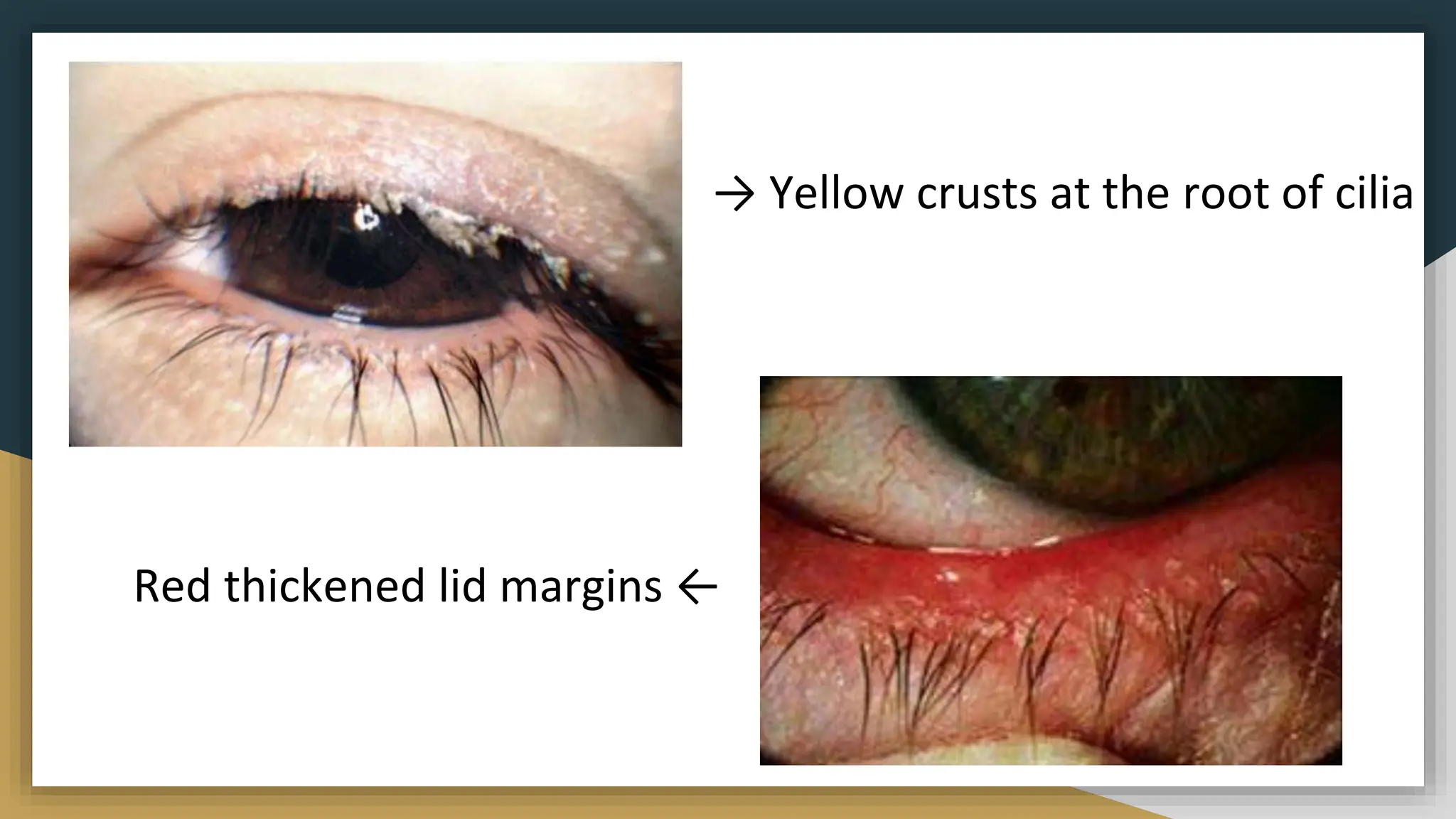 BLEPHARITIS - introduction, types, Etiology, pathogenesis, clinical ...