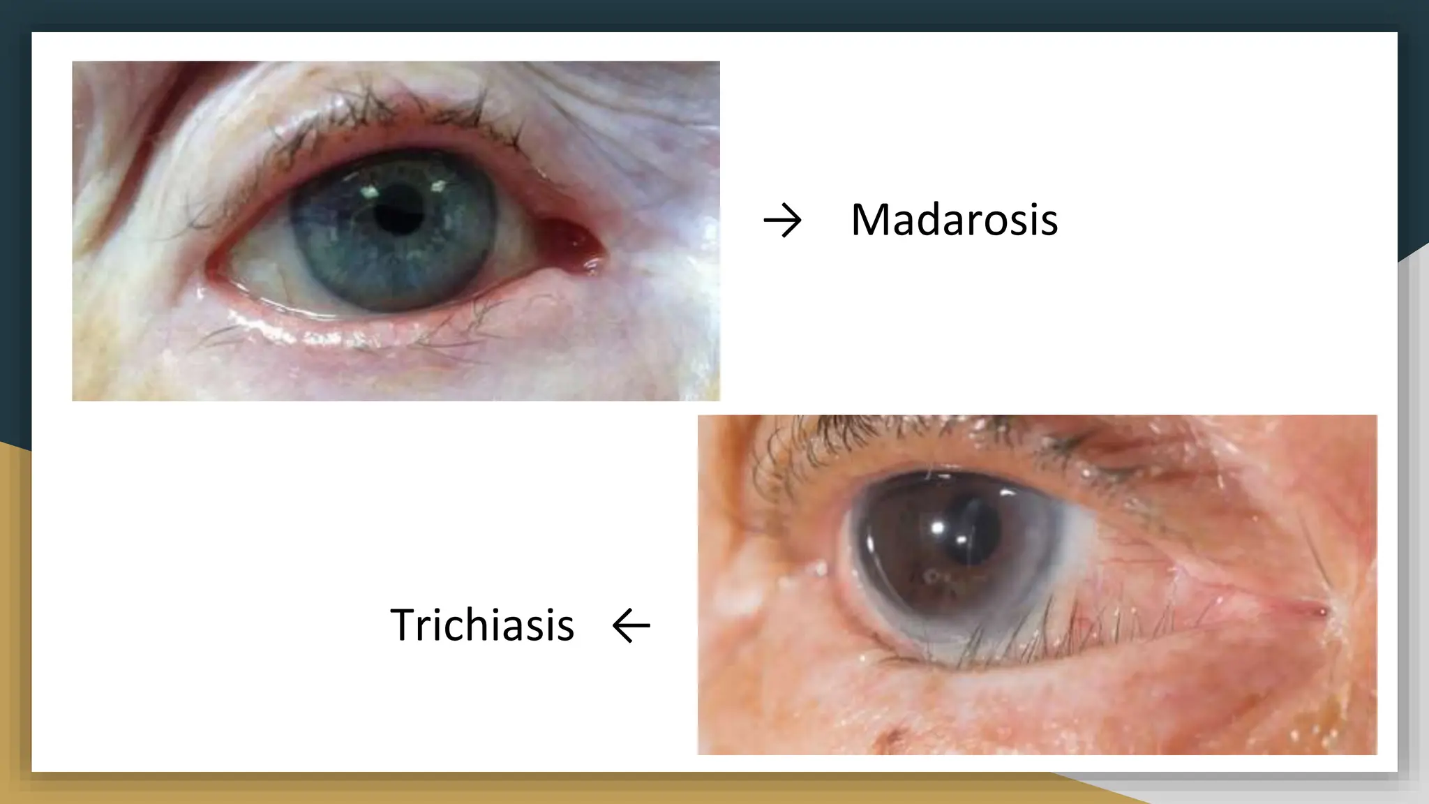 BLEPHARITIS - introduction, types, Etiology, pathogenesis, clinical ...
