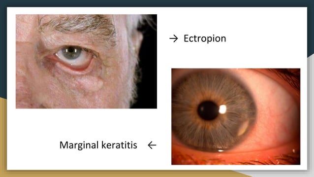 BLEPHARITIS - introduction, types, Etiology, pathogenesis, clinical ...
